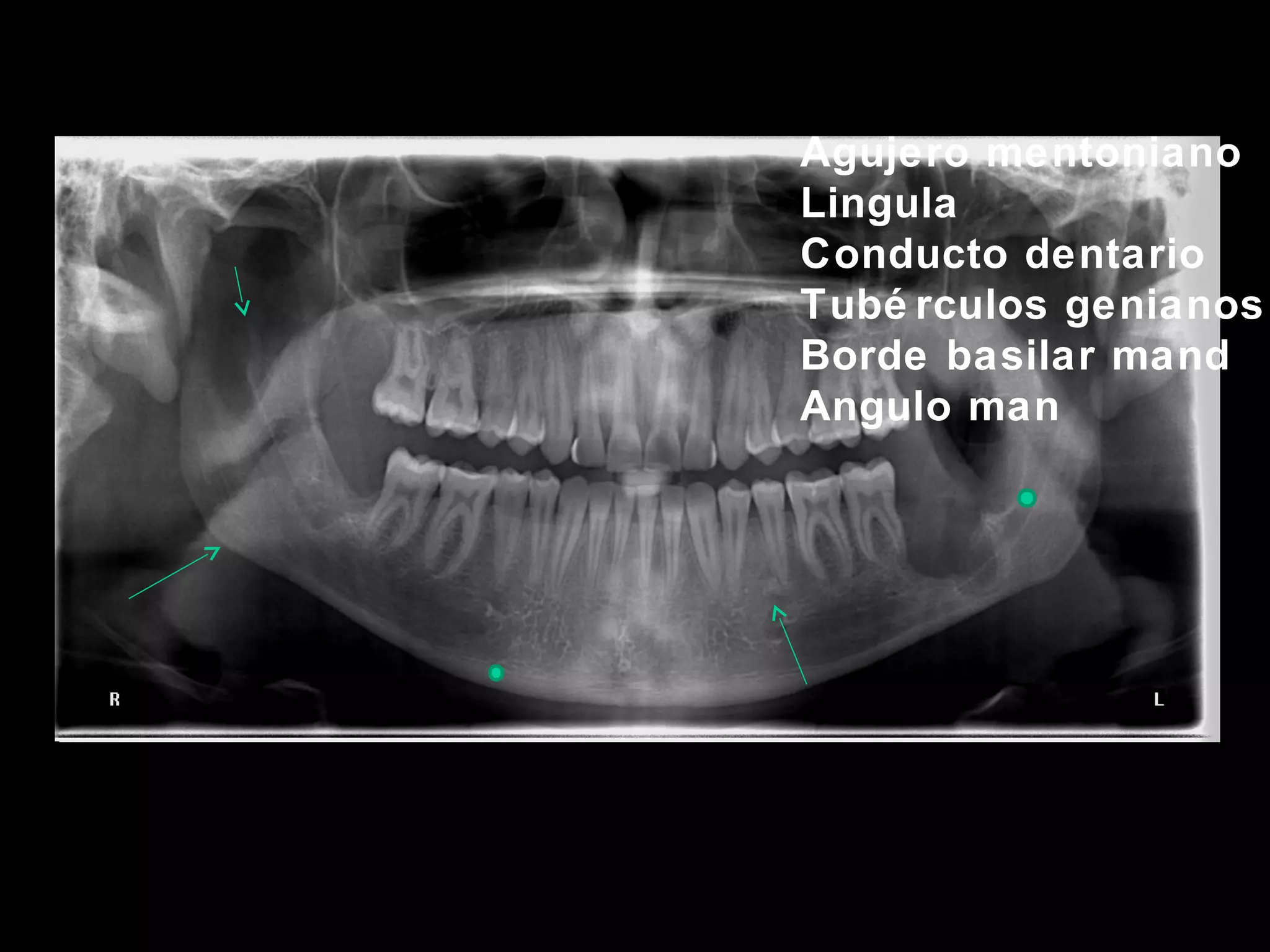 Anatomía radiográfica normal maxilar superior | PPT