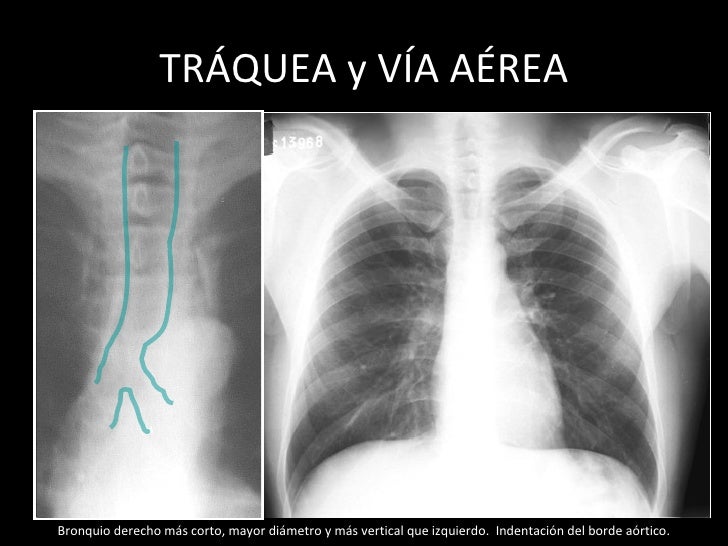Anatomía radiológica de tórax