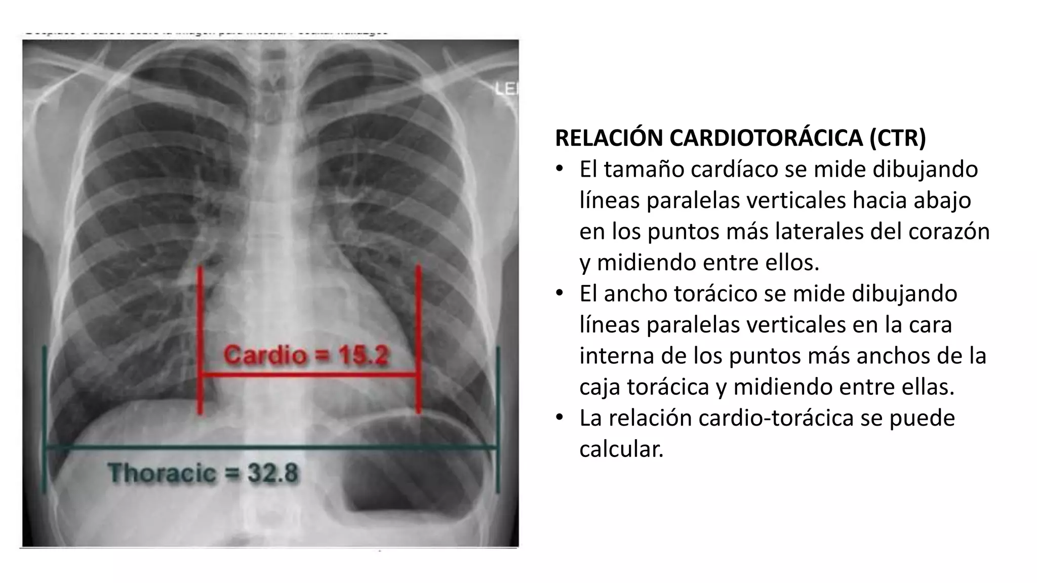 ANATOMÍA RADIOLÓGICA Y PROYECCIONES DE RX DE TÓRAX.pptx