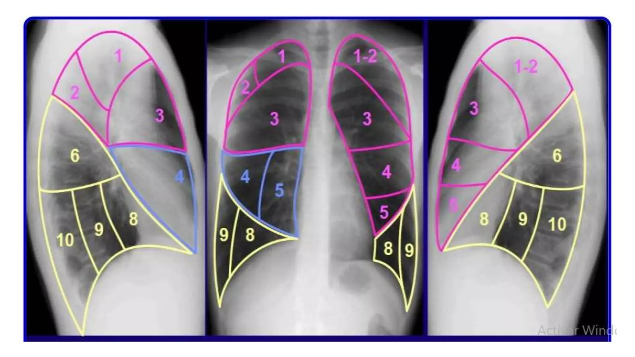 ANATOMÍA RADIOLÓGICA Y PROYECCIONES DE RX DE TÓRAX.pptx
