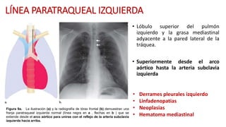 ANATOMÍA RADIOLÓGICA Y PROYECCIONES DE RX DE TÓRAX.pptx