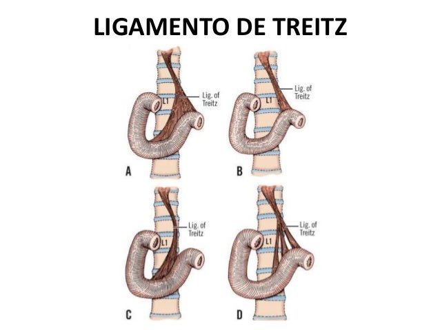 Ligamento De Treitz