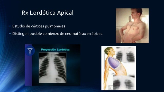 Anatomía y radiología torácica