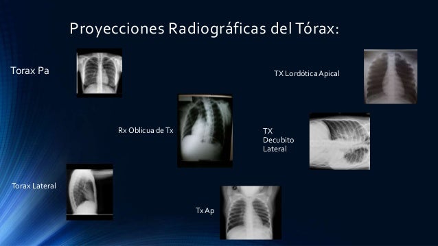Anatomía y radiología torácica