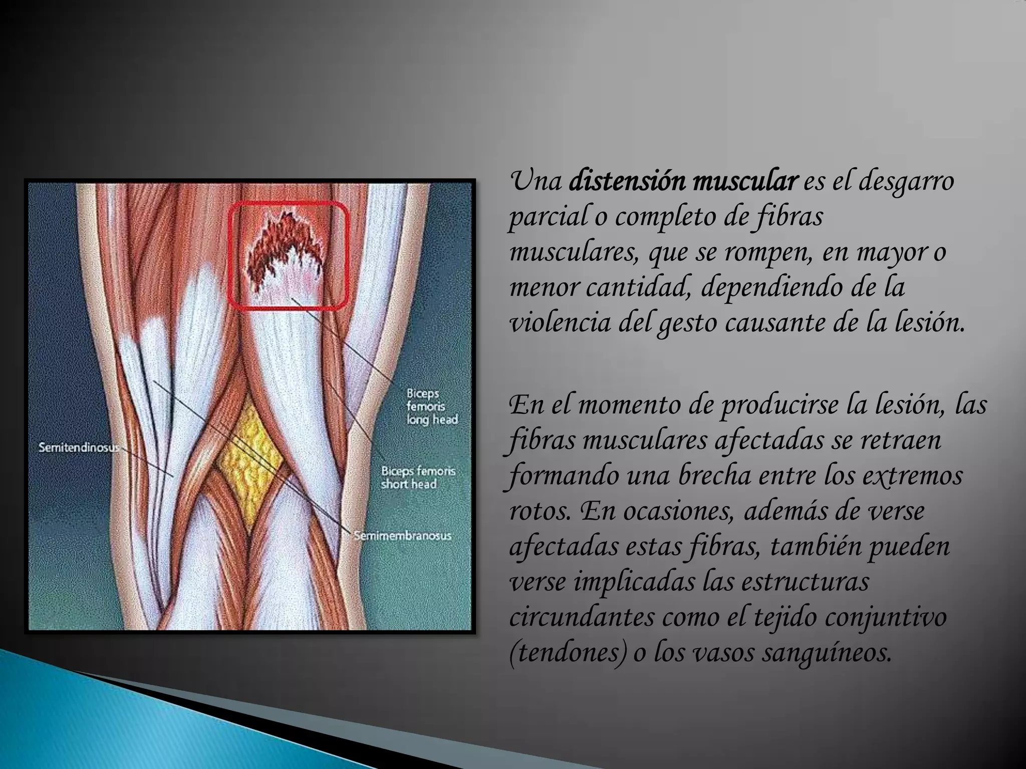Distención Muscular | PPTX