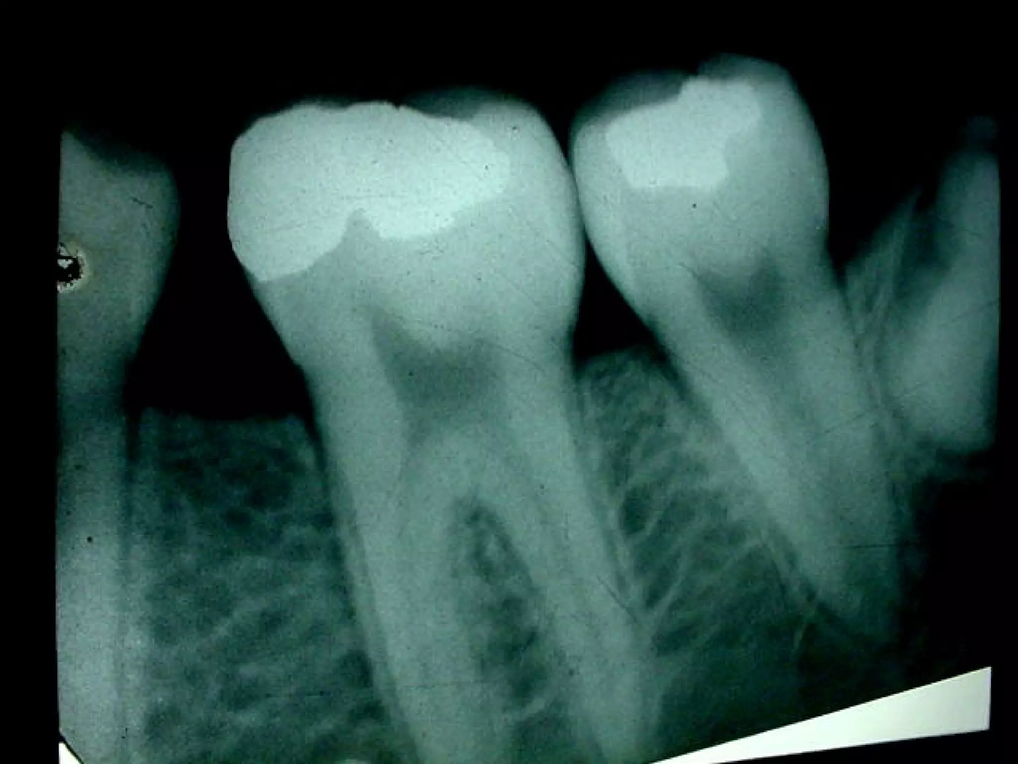 Anatomia De Los Conducto Radiculares F | PPT | Dental Health | Diseases ...