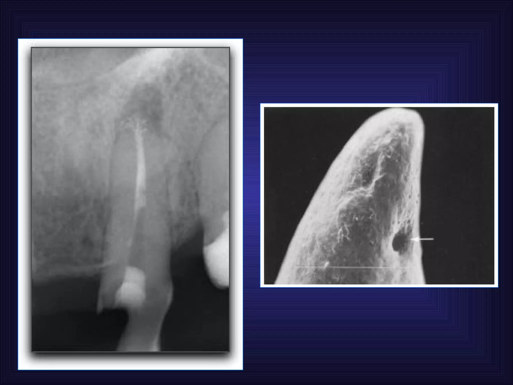 Anatomia De Los Conducto Radiculares F | PPT | Dental Health | Diseases ...