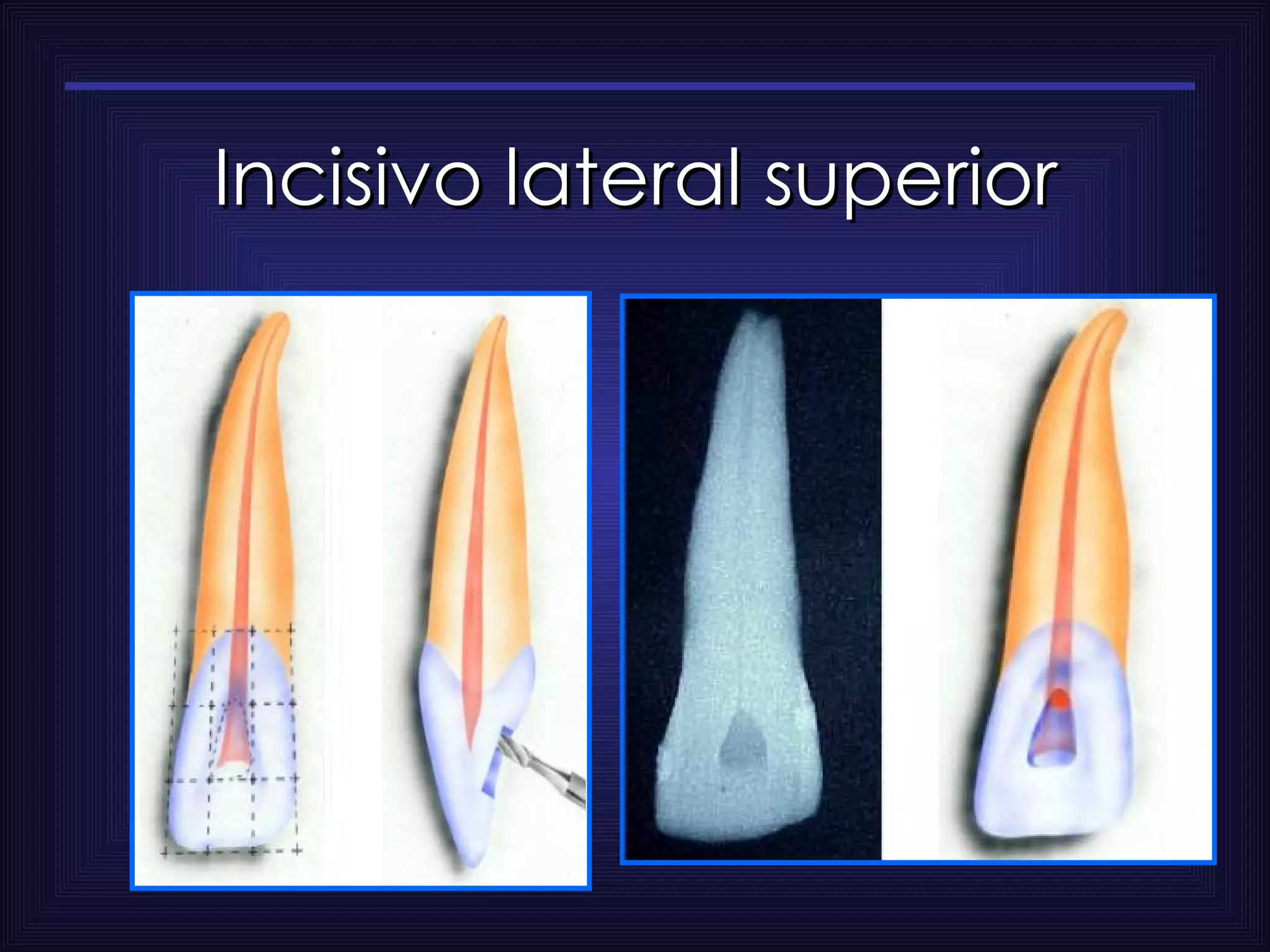 Anatomia De Los Conducto Radiculares F | PPT | Dental Health | Diseases ...