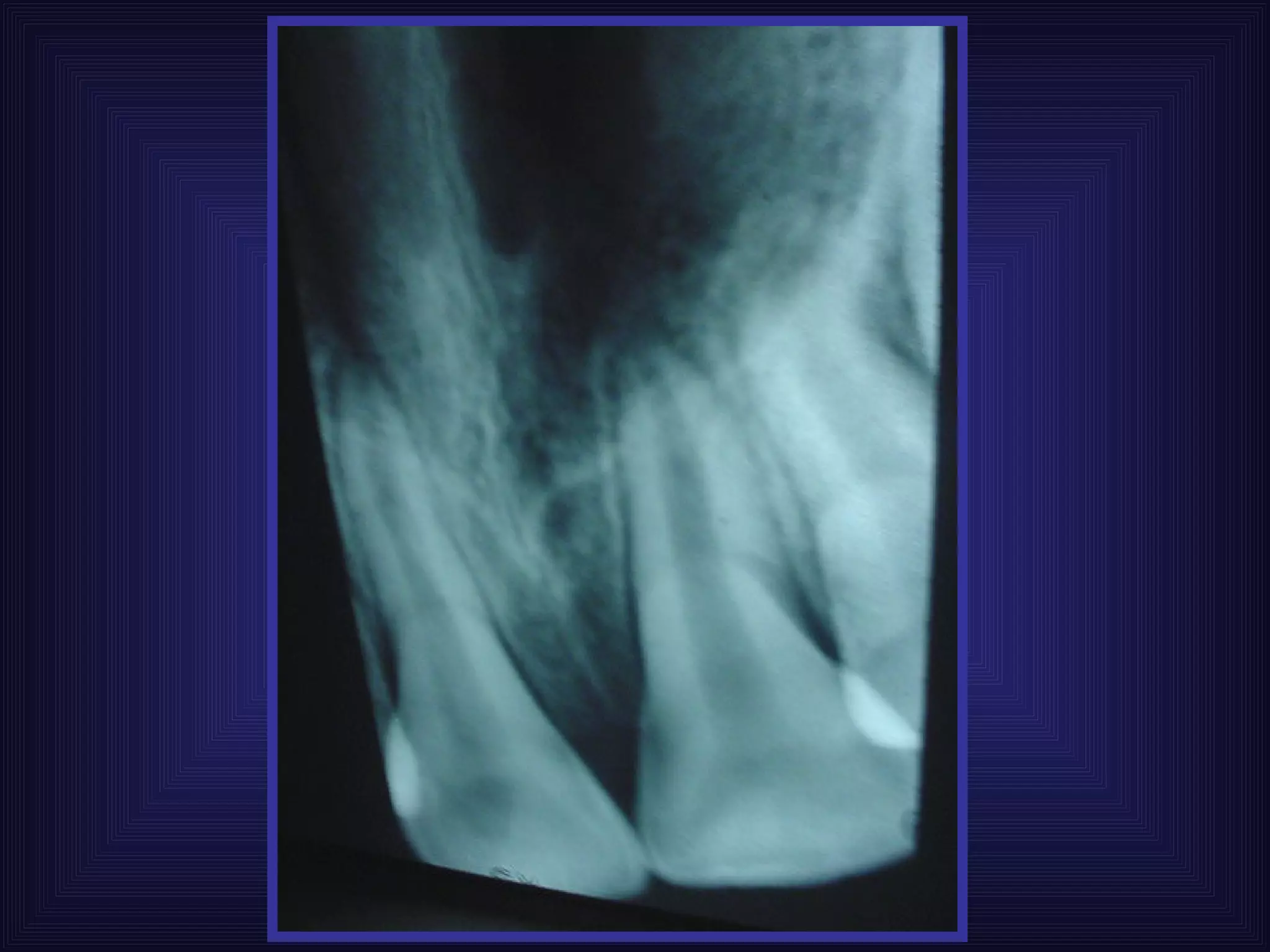 Anatomia De Los Conducto Radiculares F | PPT | Dental Health | Diseases ...