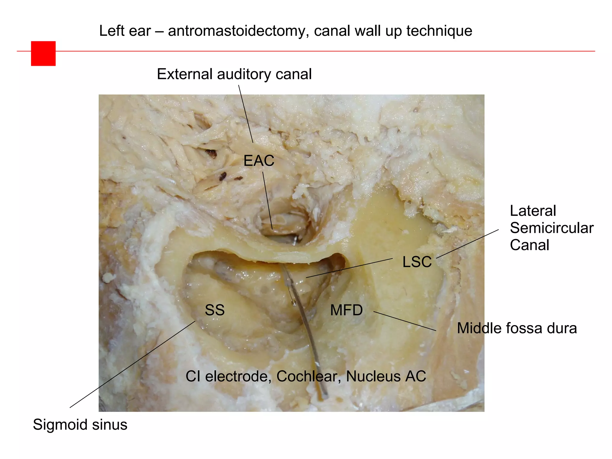 Clinical anatomy of the middle ear | PPT