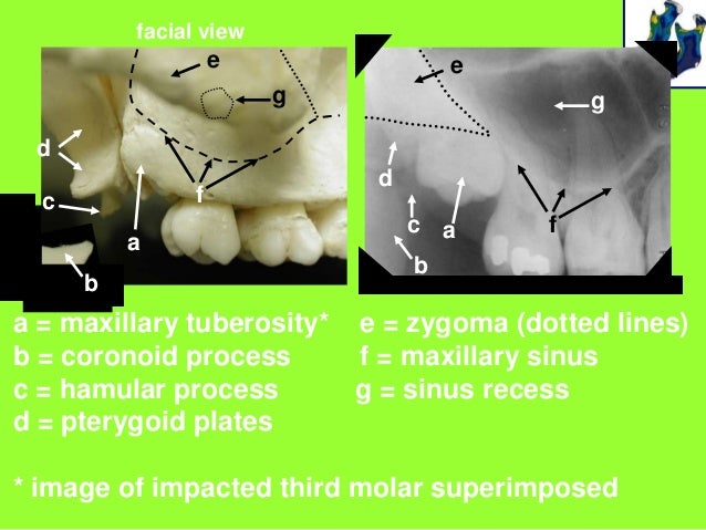 Hamular Process