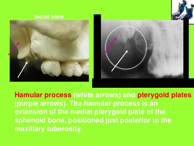 Hamular Process