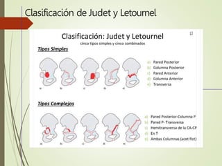 ANATOMIA ACETABULO - PSEUDOARTROSIS.pptx