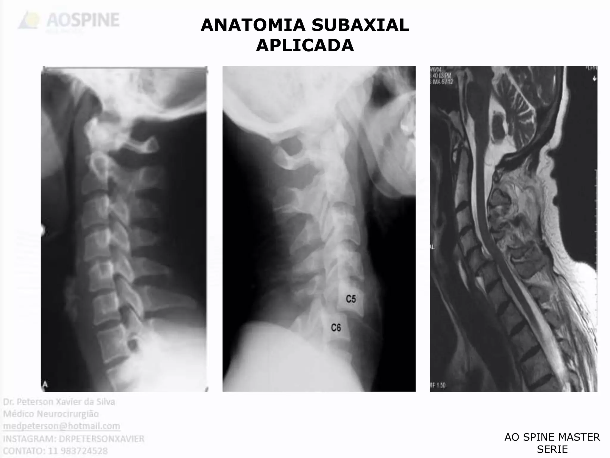 Anatomia Aplicada da Coluna Cervical | PPT