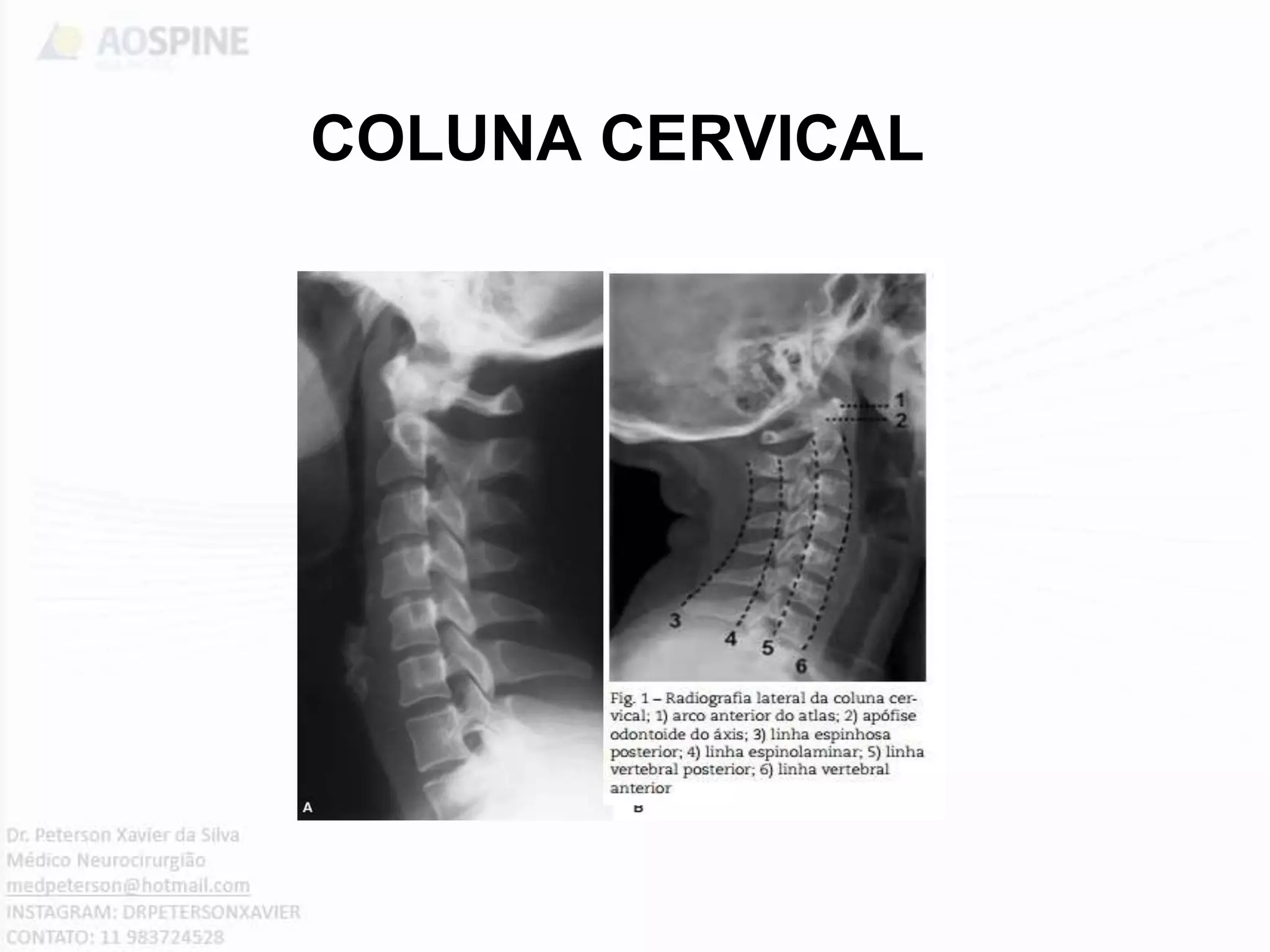 Anatomia Aplicada da Coluna Cervical | PPT