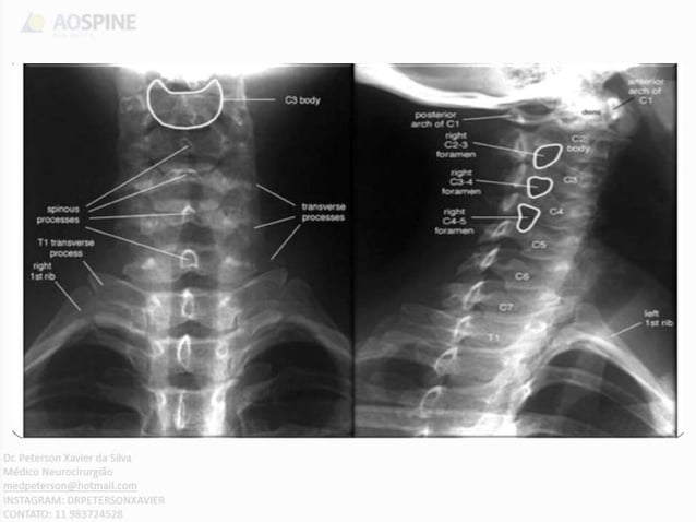 Anatomia Aplicada da Coluna Cervical | PPT