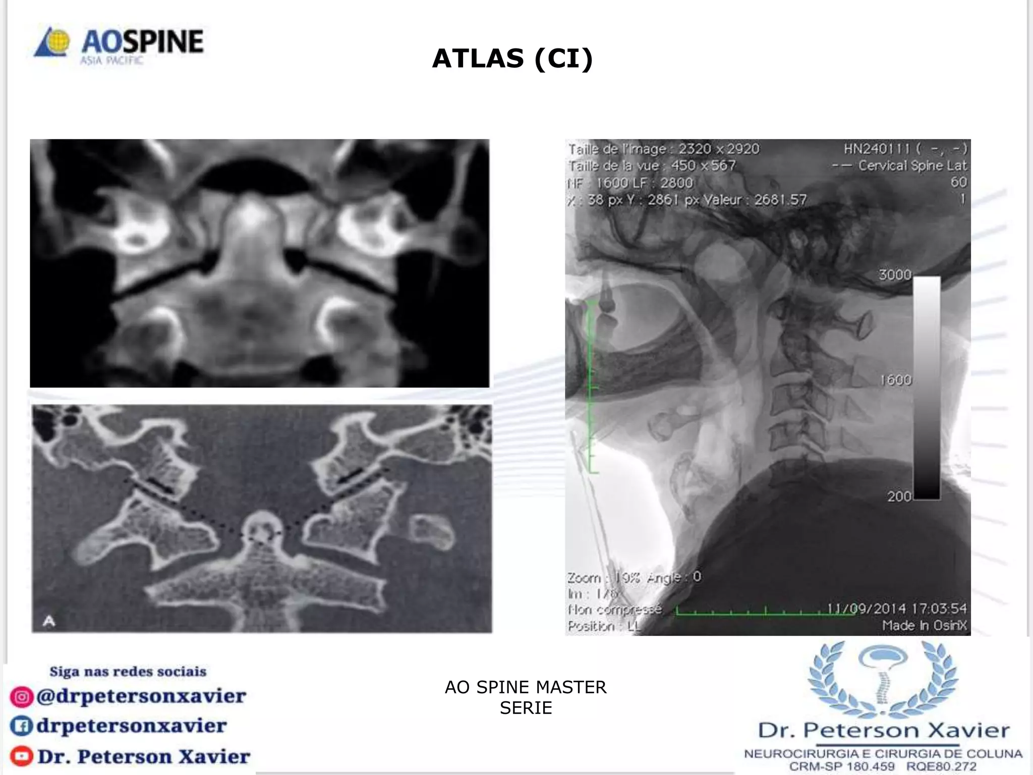 Anatomia Aplicada da Coluna Cervical | PPT