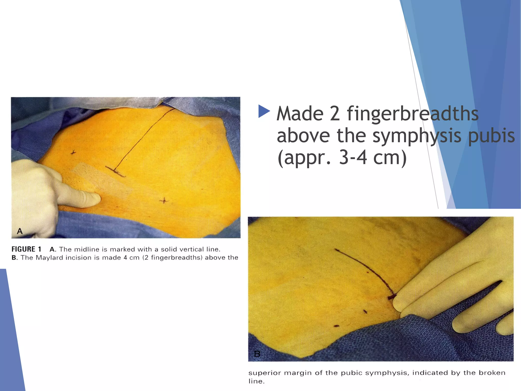 Abdominal incision and abdominal anatomy | PPT