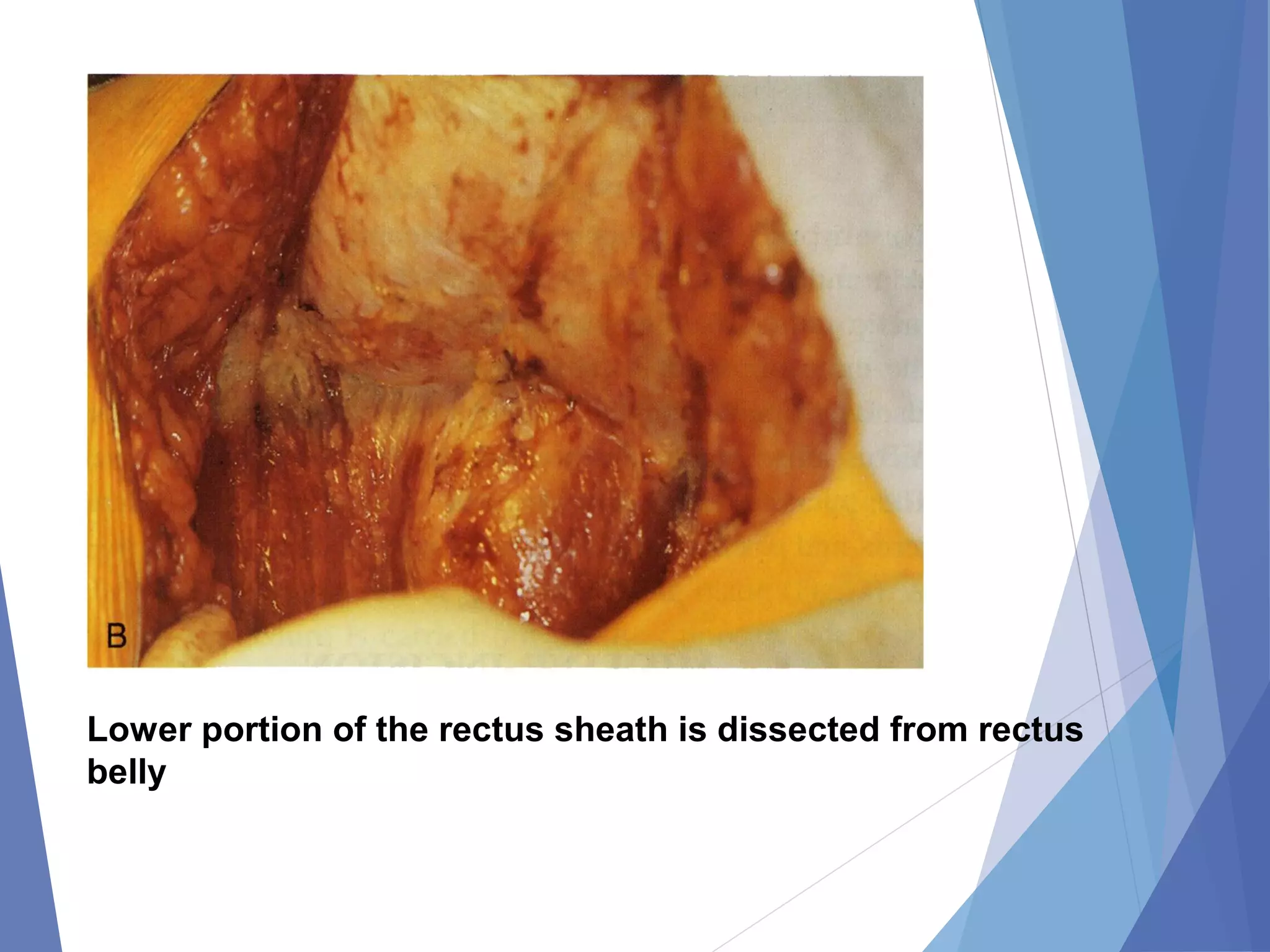 Abdominal incision and abdominal anatomy | PPT