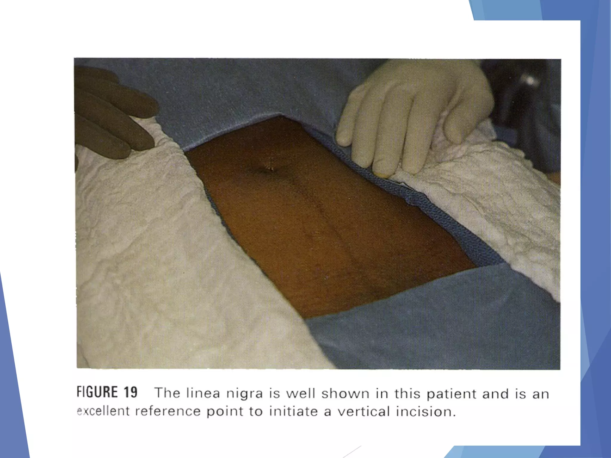 Abdominal incision and abdominal anatomy | PPT