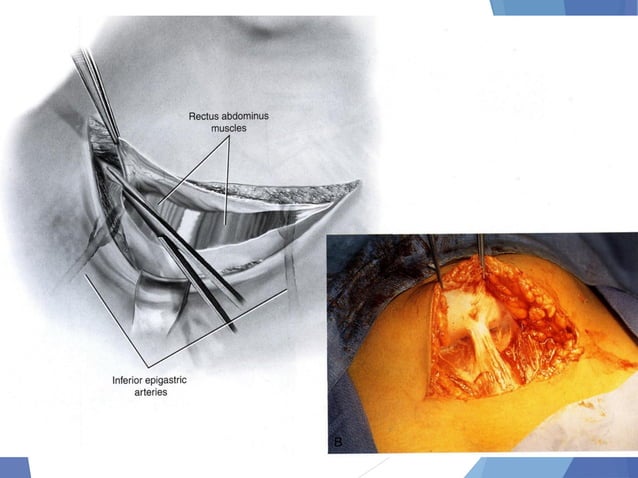 Abdominal incision and abdominal anatomy | PPT | Pregnancy ...
