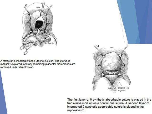 Abdominal incision and abdominal anatomy | PPT | Pregnancy ...