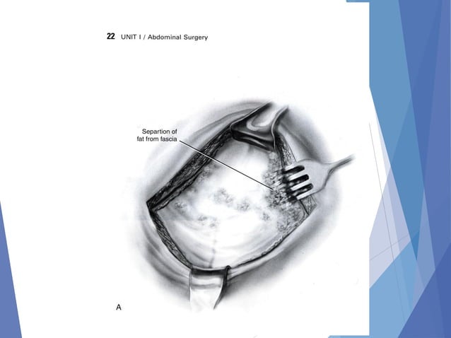 Abdominal incision and abdominal anatomy | PPT | Pregnancy ...