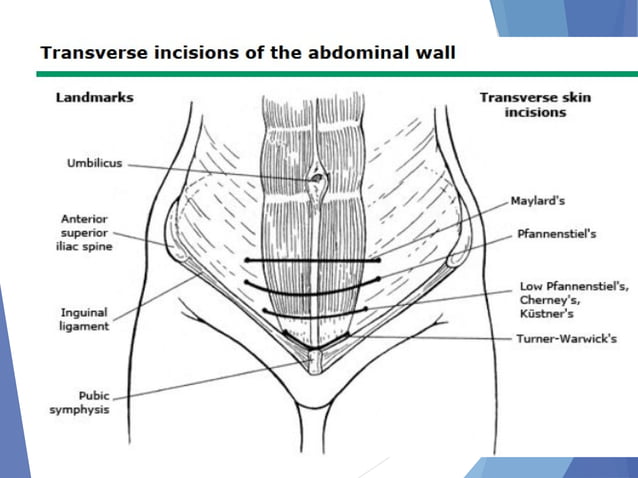 Abdominal incision and abdominal anatomy