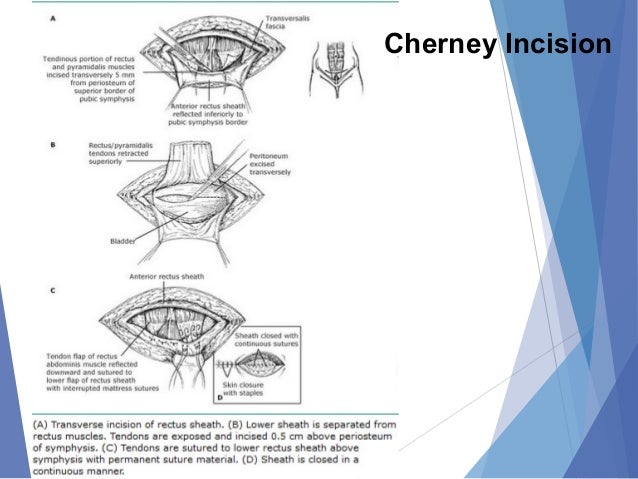 Abdominal incision and abdominal anatomy