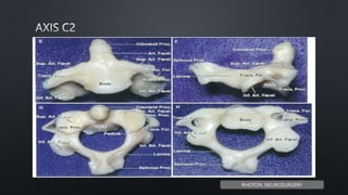 ANATOMIA C1 - C2 - LIGAMENTOS NUEROANATOMIA | PPTX | Physical Therapy ...
