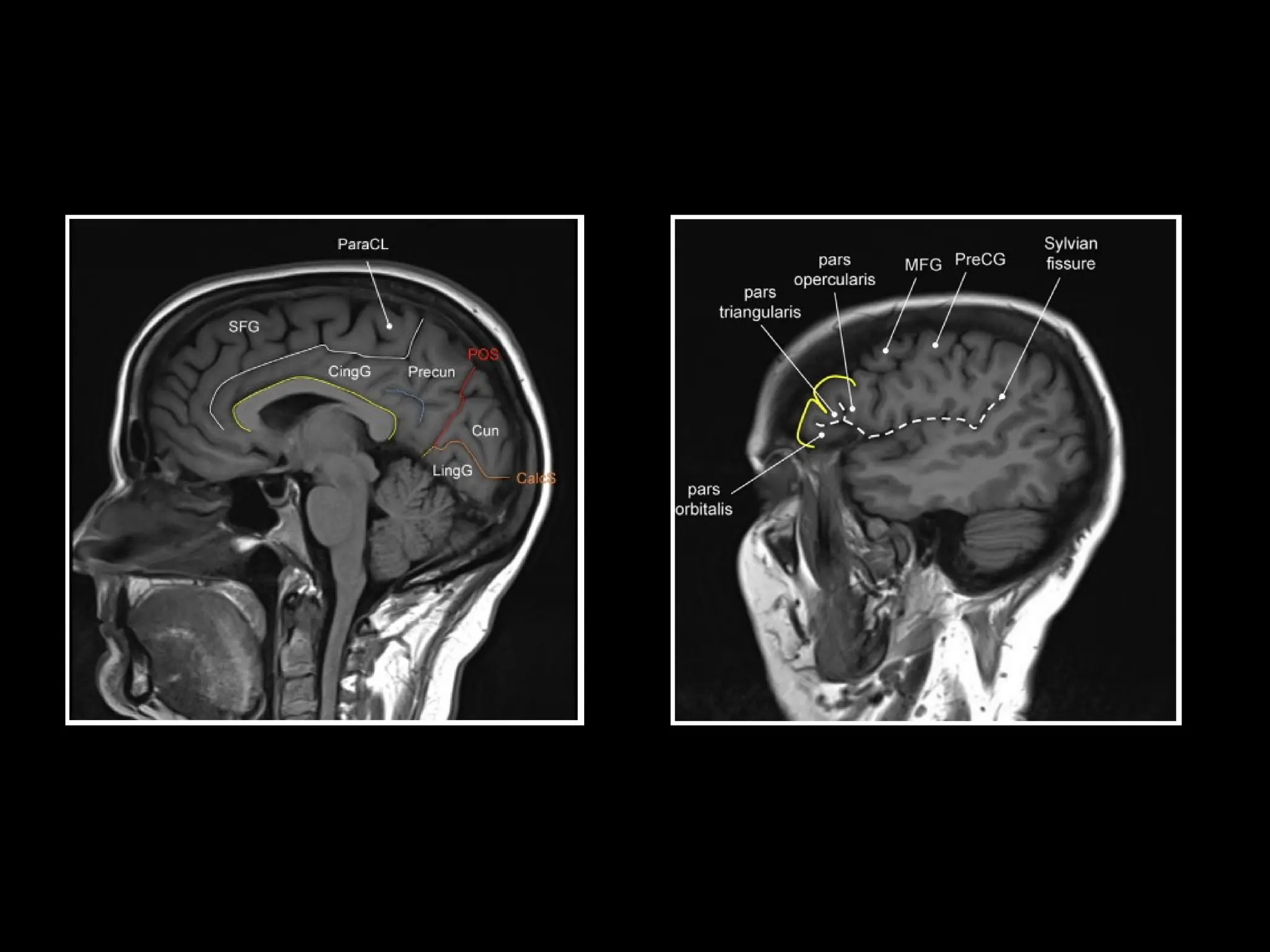 ANATOMIA CEREBRAL HEMISFERIOS Y CIRCUNVOLUCIONES R2. AYALA.pptx
