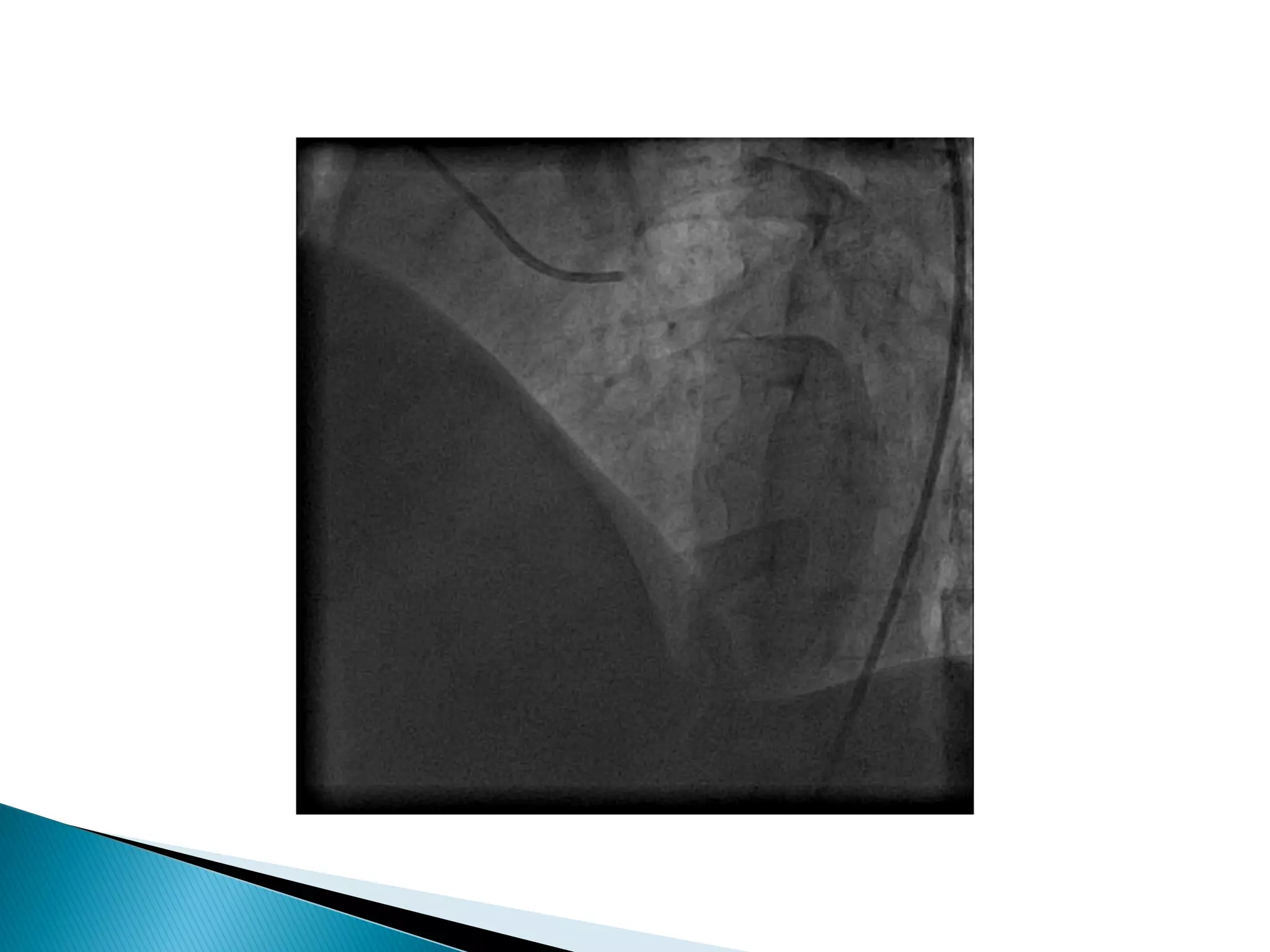 Anatomía coronaria básica - Coronariografía. Visualización de las ...