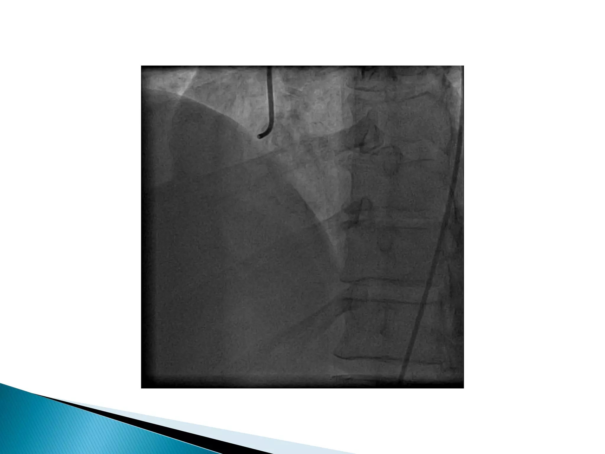 Anatomía coronaria básica - Coronariografía. Visualización de las ...