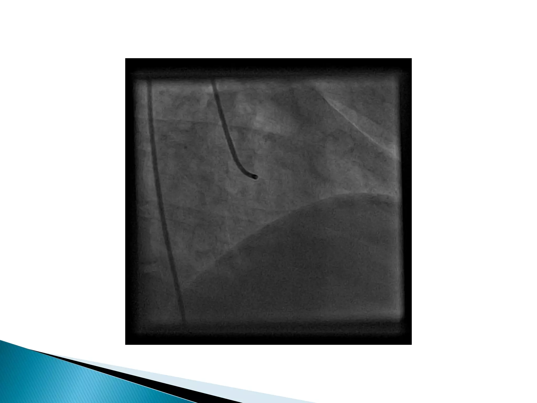 Anatomía coronaria básica - Coronariografía. Visualización de las ...