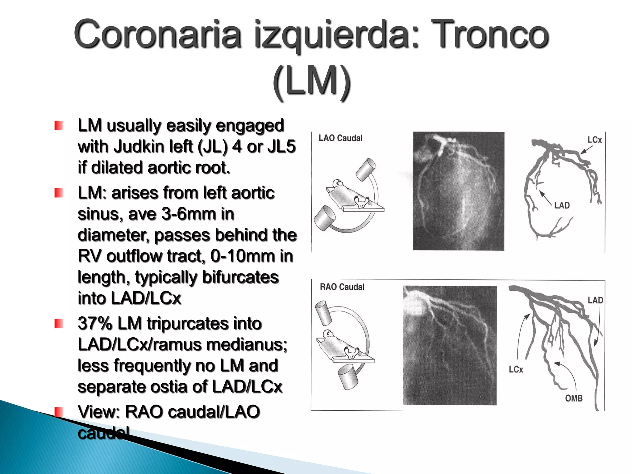 Anatomía coronaria básica - Coronariografía. Visualización de las ...