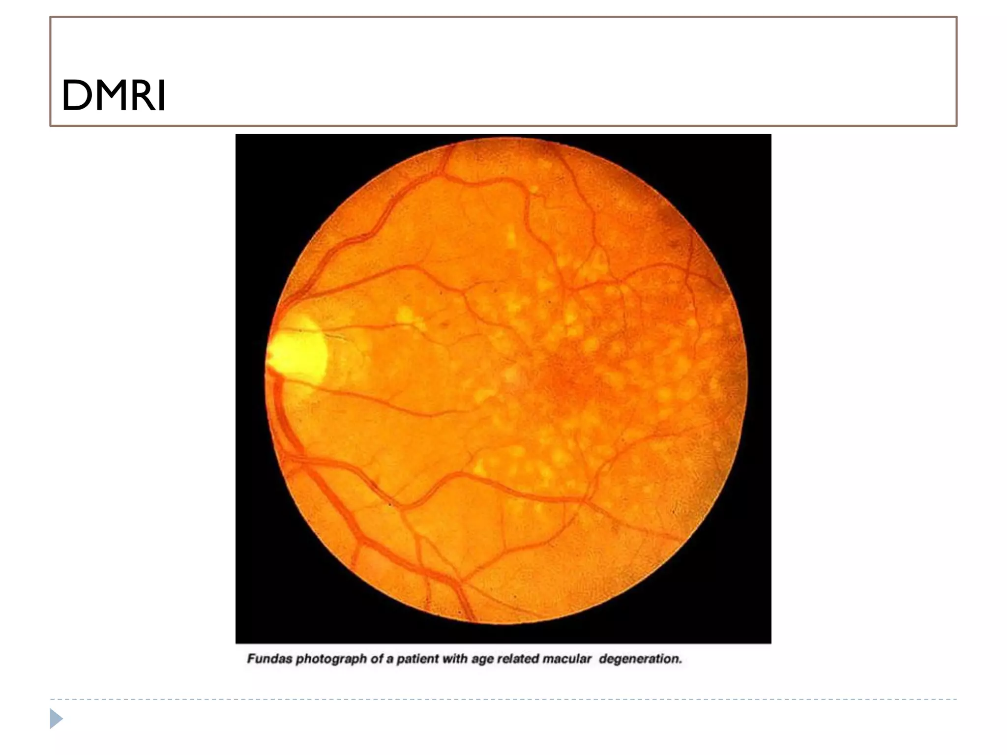 Anatomia da retina e vítreo | PDF