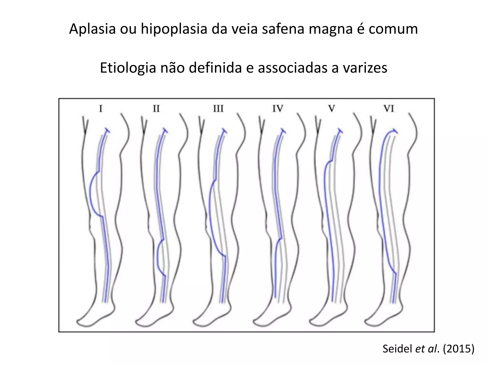 Anatomia da veia safena magna | PPTX