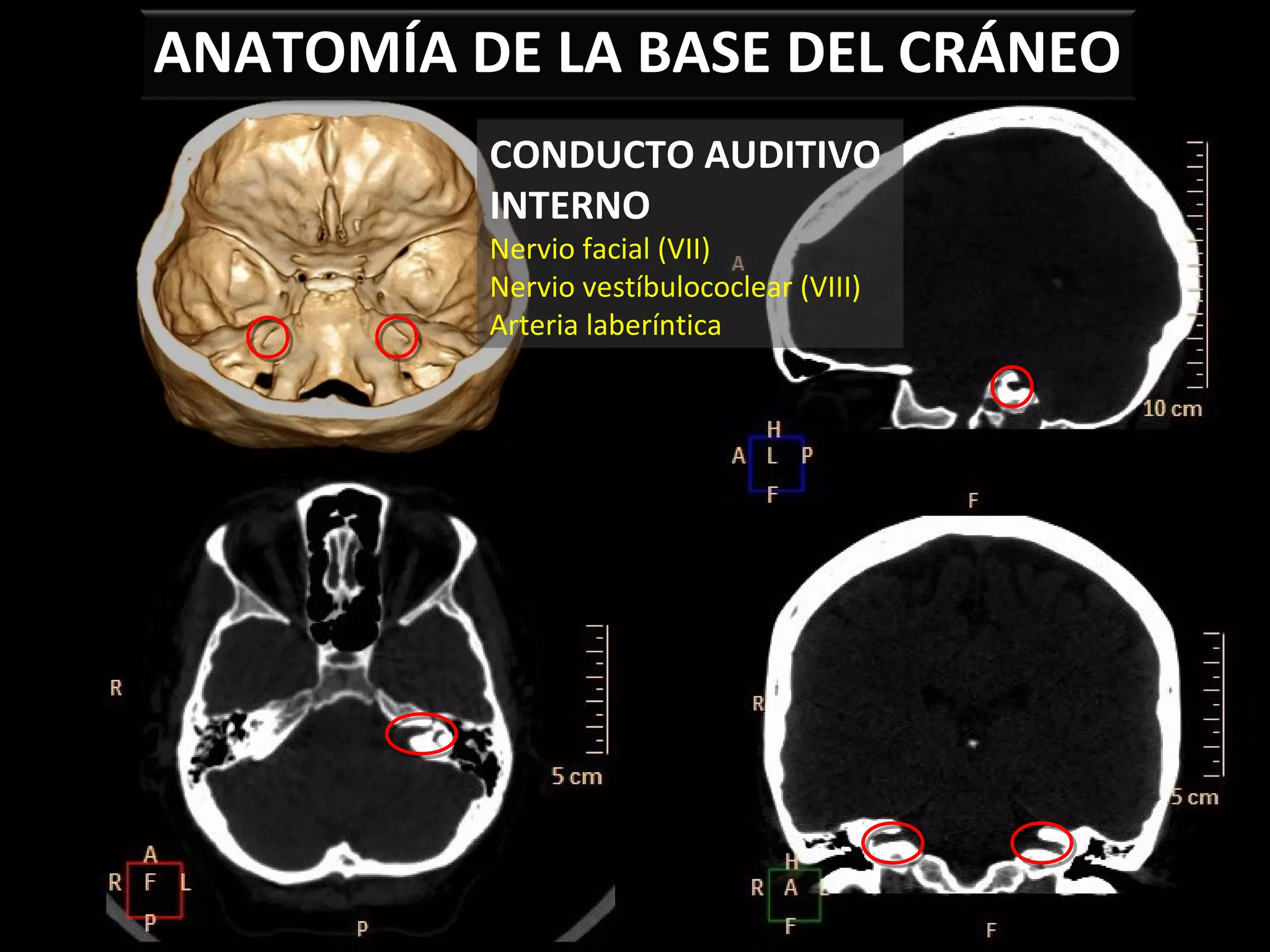 Anatomia de la base del craneo | PPT | Bone and Joint Conditions ...