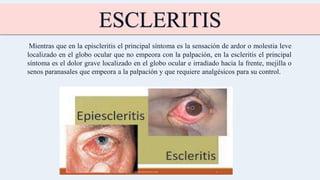 Anatomía de la Esclera y clasificación. | PPTX