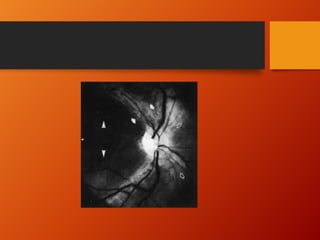Anatomia de la via visual | PPTX