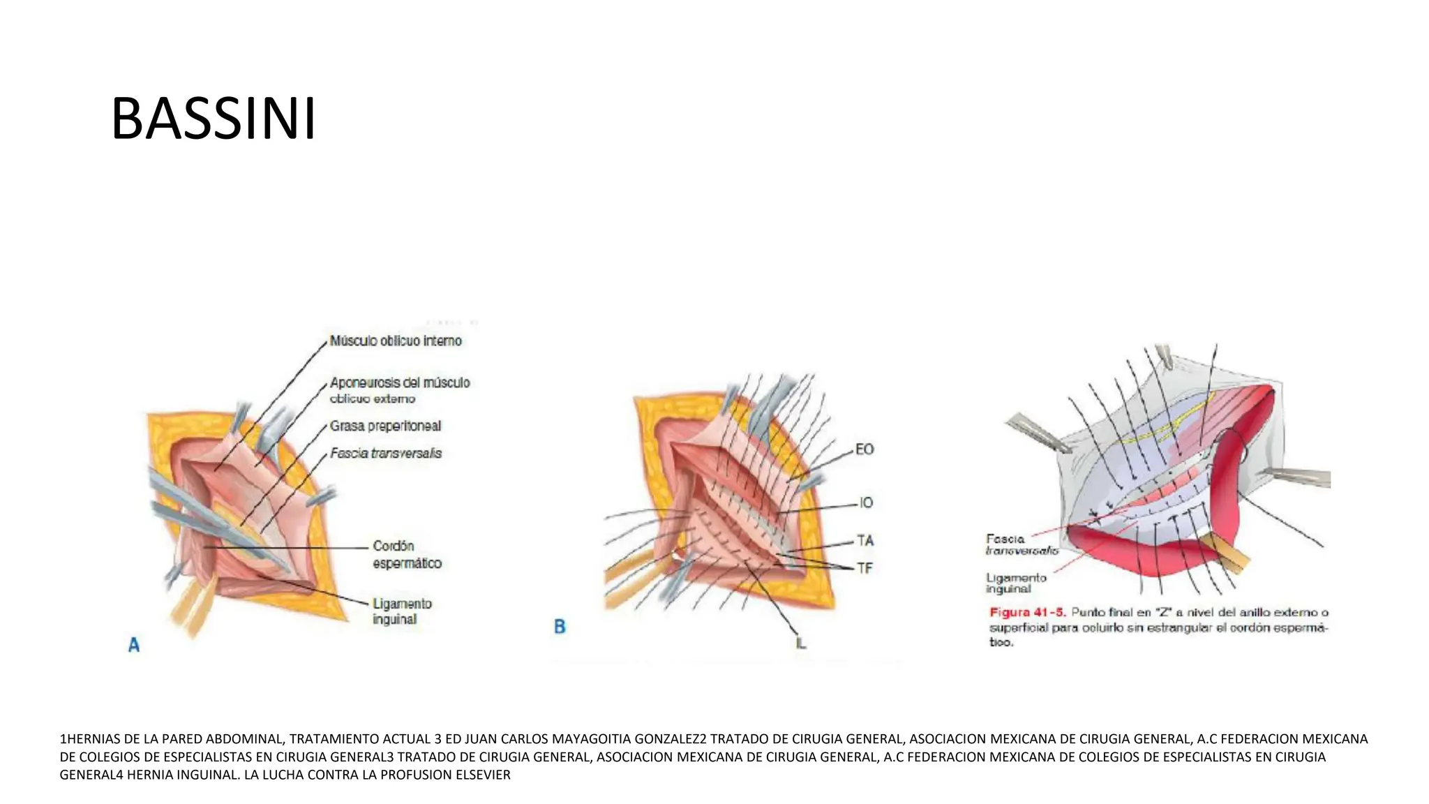 Anatomía del canal inguinal, hernias inguinales y [Autoguardado].pptx