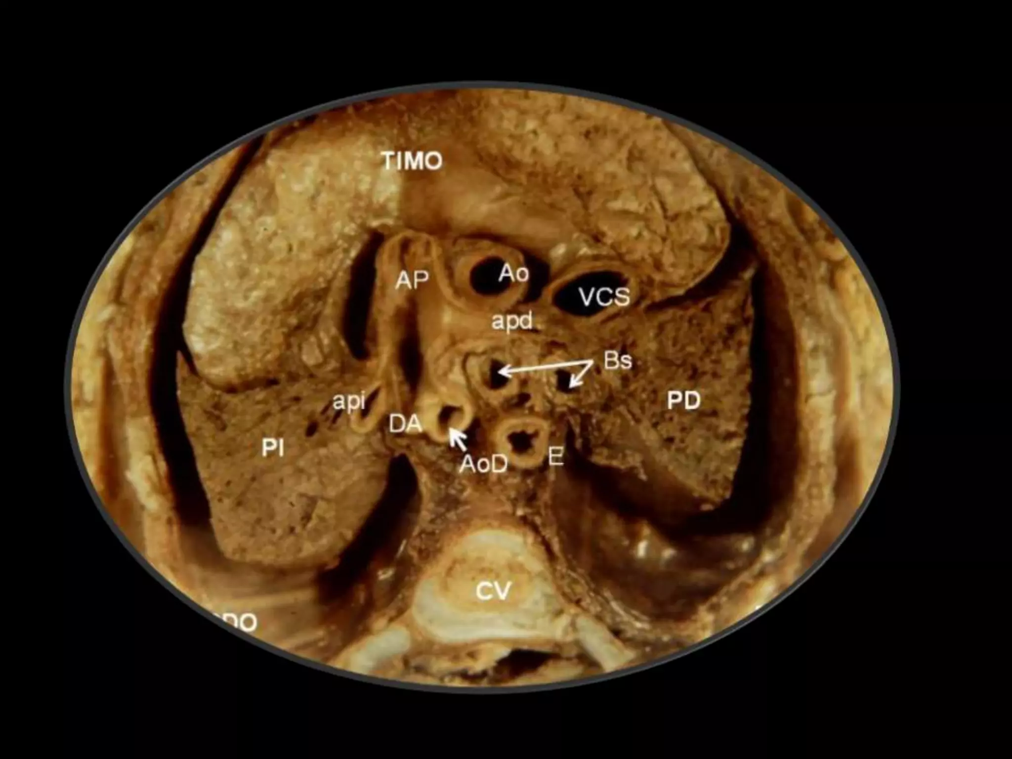 Anatomia del corazon fetal | PPTX