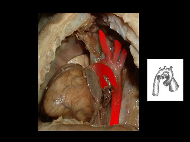 Anatomia del corazon fetal | PPTX