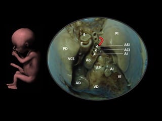 Anatomia del corazon fetal | PPTX
