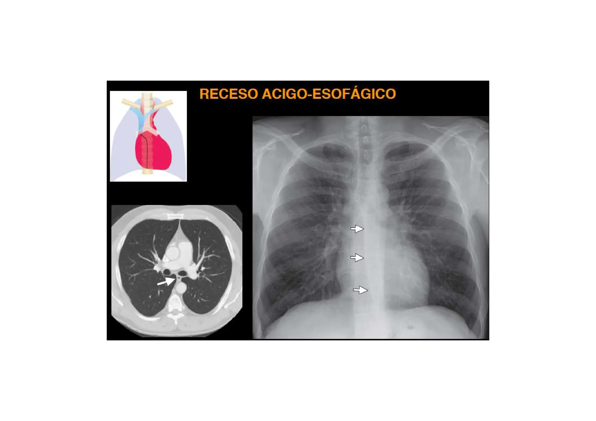 Anatomía y proyecciones radiológicas del torax | PDF