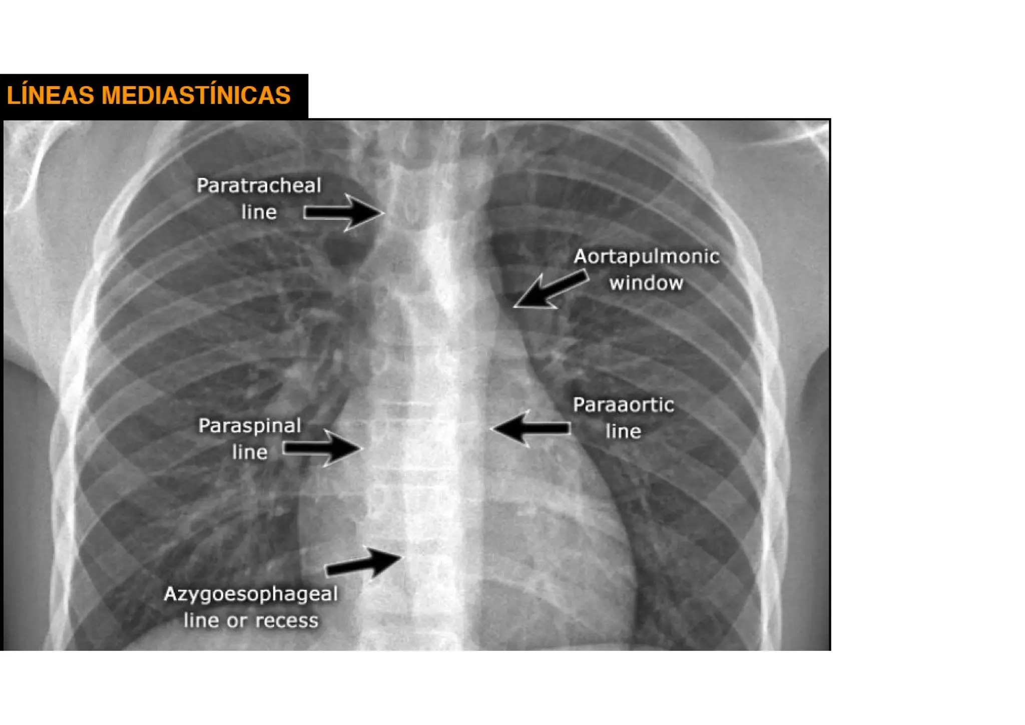 Anatomía y proyecciones radiológicas del torax | PDF
