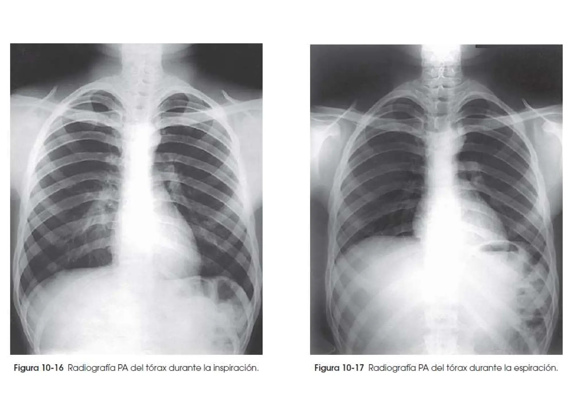 Anatomía y proyecciones radiológicas del torax | PDF