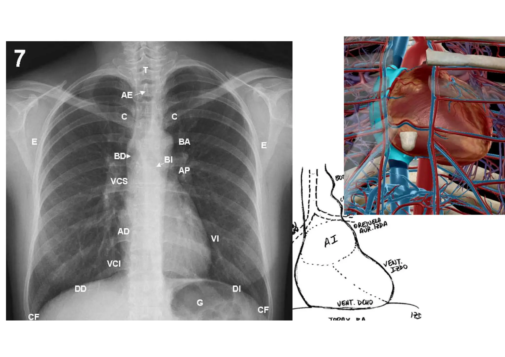 Anatomía y proyecciones radiológicas del torax | PDF