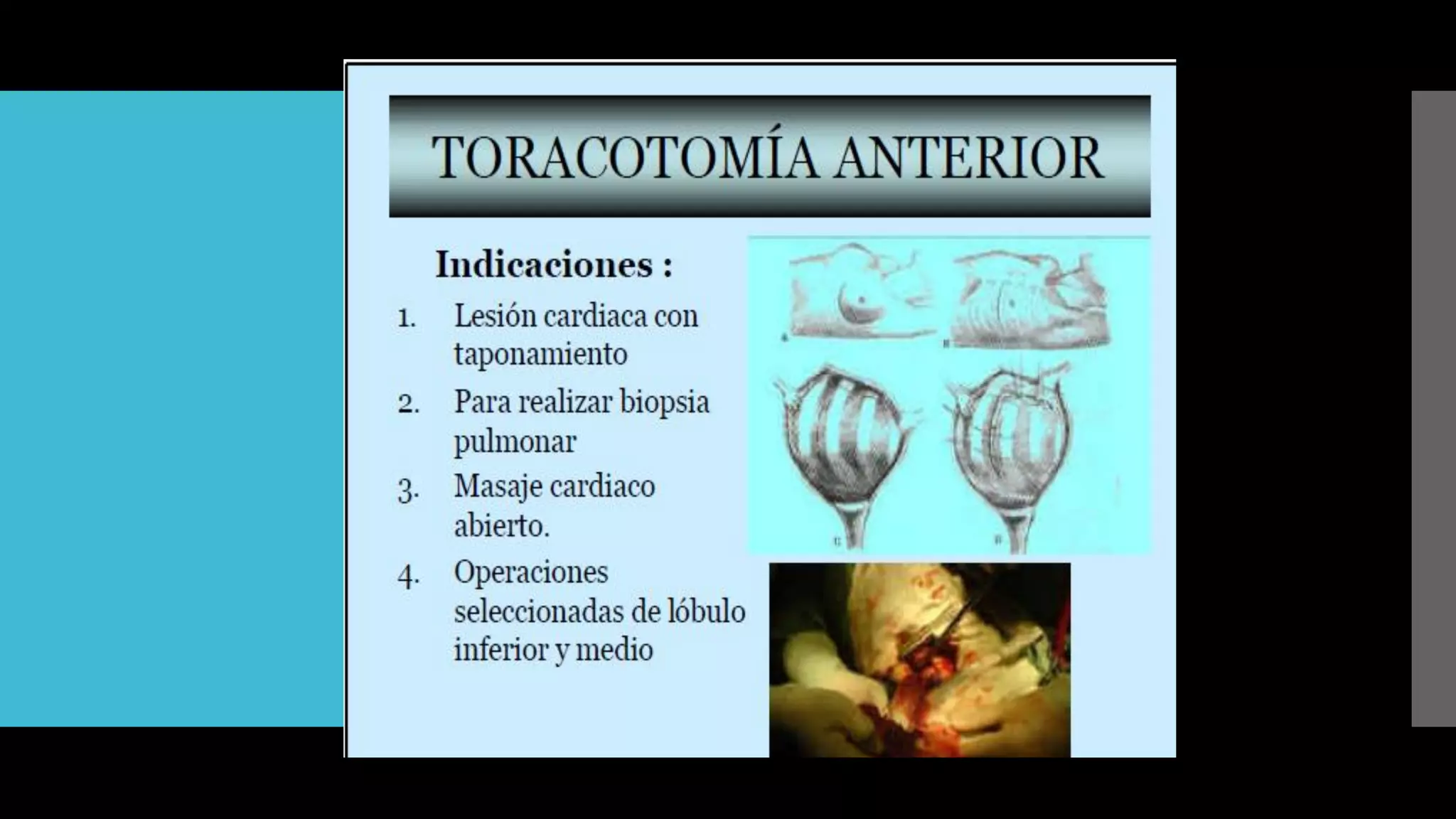 ☆ANATOMIA DEL TORAX Y TORACOTOMIA (1) (2).pdf