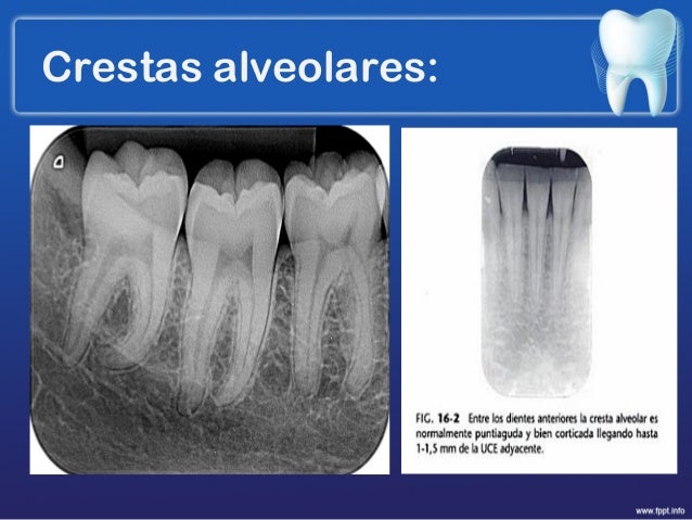Hueso Alveolar